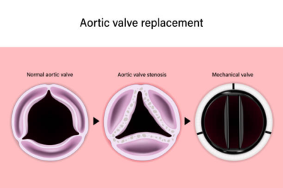 Aortic Valve Repair & Replacement Surgery in Mumbai - Dr. Vishal Khullar