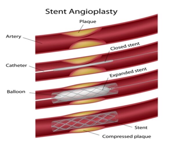 Coronary Angioplasty and Stents – Procedure, Risks, and Prevention